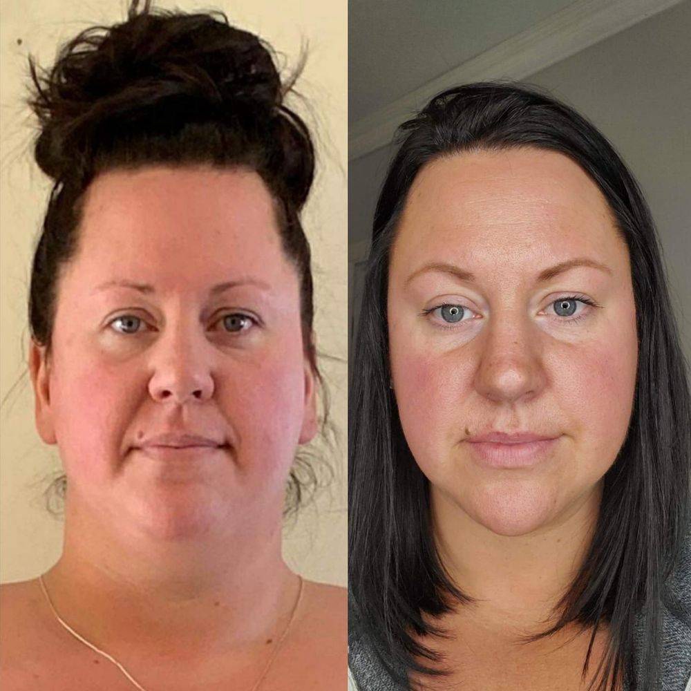 Neveskin Slim, Tighten & Tone – Zatara Day Spa